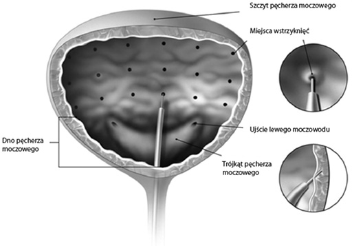 Leczenie pęcherza Neurogennego - program NFZ